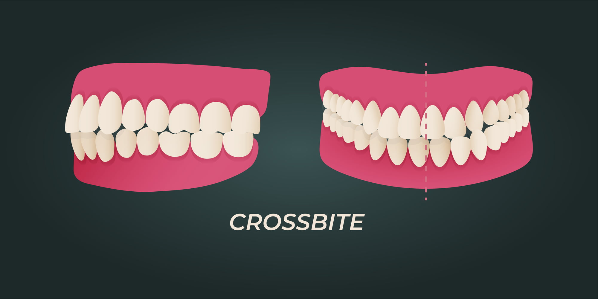 7 Types of Malocclusion | AllSmiles Dental Care