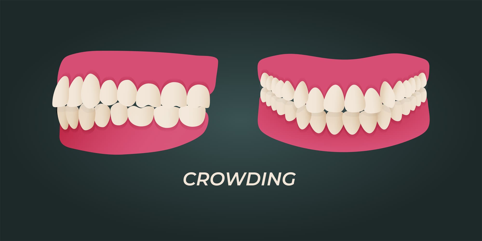 7 Types of Malocclusion | AllSmiles Dental Care