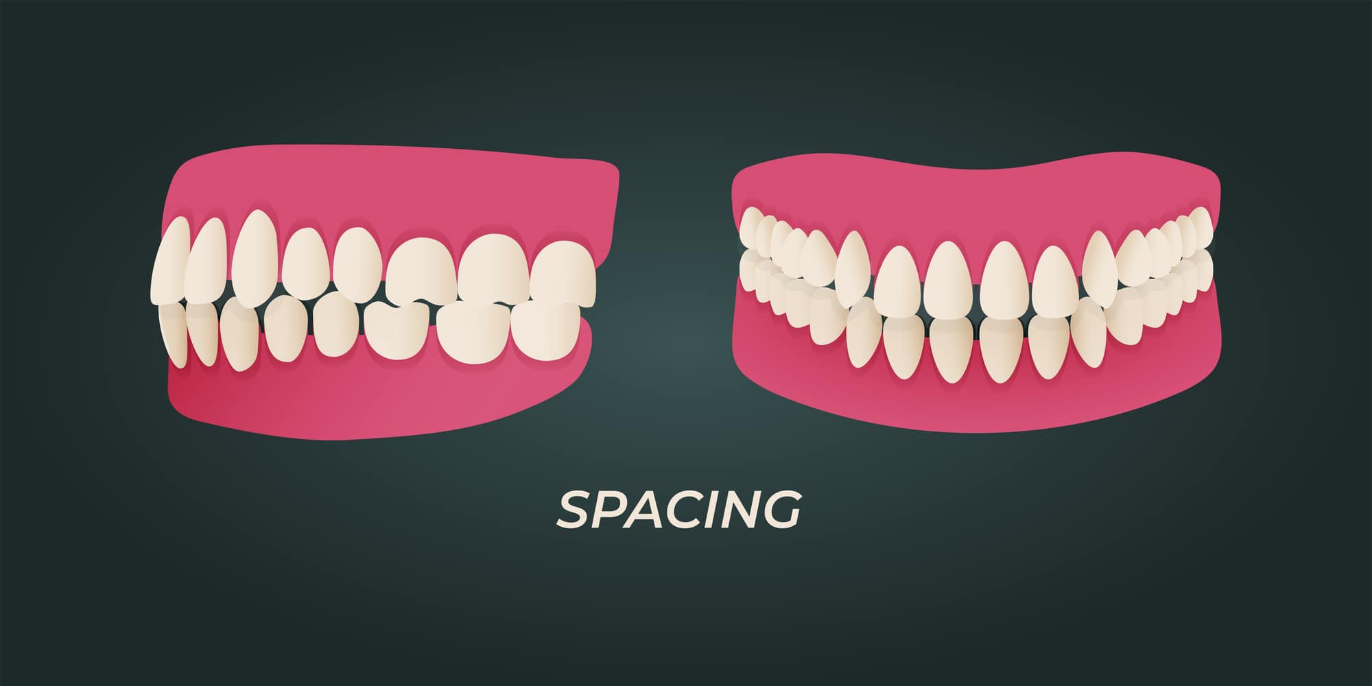 7 Types of Malocclusion | AllSmiles Dental Care