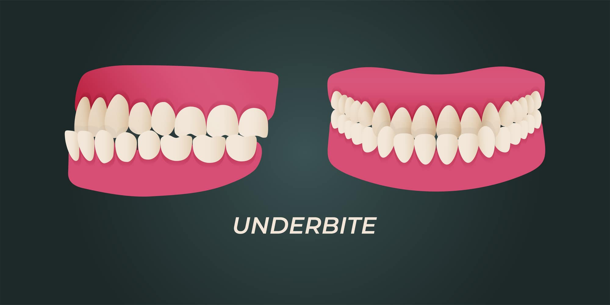 7 Types of Malocclusion - AllSmiles Dental Care